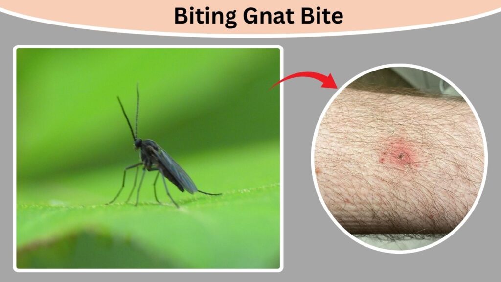 25 Types Of Insects Bites: Identification, Symptom with Pictures