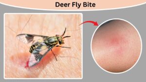 25 Types Of Insects Bites: Identification, Symptom with Pictures