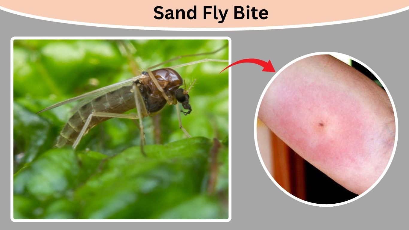 25 Types Of Insects Bites: Identification, Symptom with Pictures