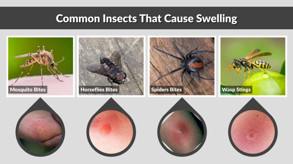 Insect Bites and Stings Swelling and How to Treat