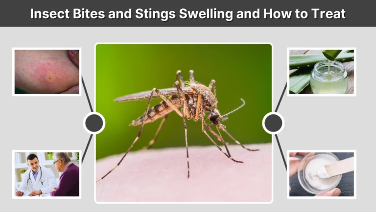 Insect Bites and Stings Swelling and How to Treat