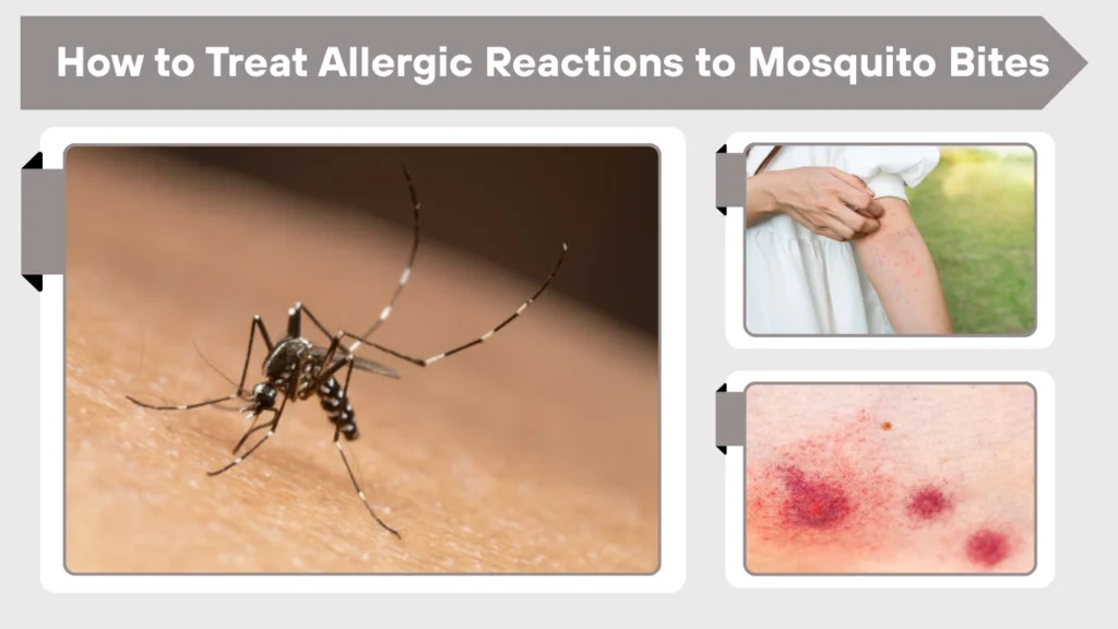 How to Treat Mosquito Bites Fast: Itching, Swelling & Allergy