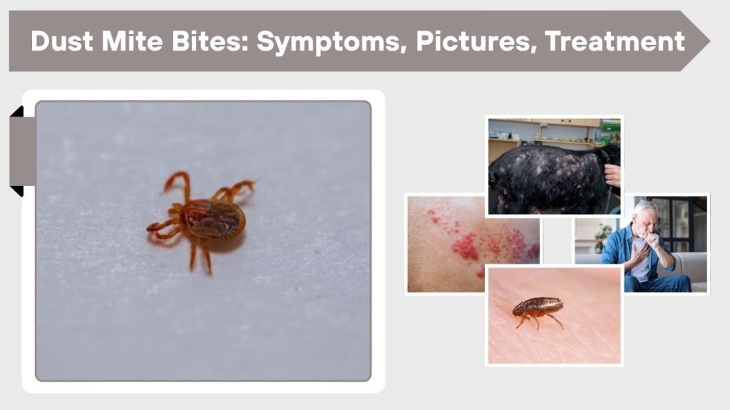 Dust Mite Bites: Symptoms, Pictures, Treatment & Bed Bug Comparison