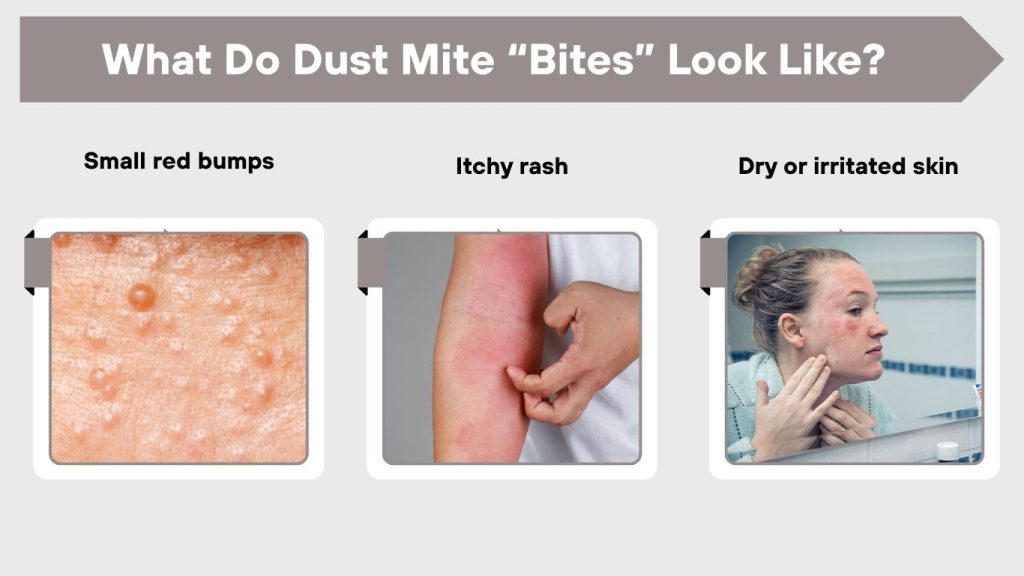 Dust Mite Bites: Symptoms, Pictures, Treatment & Bed Bug Comparison