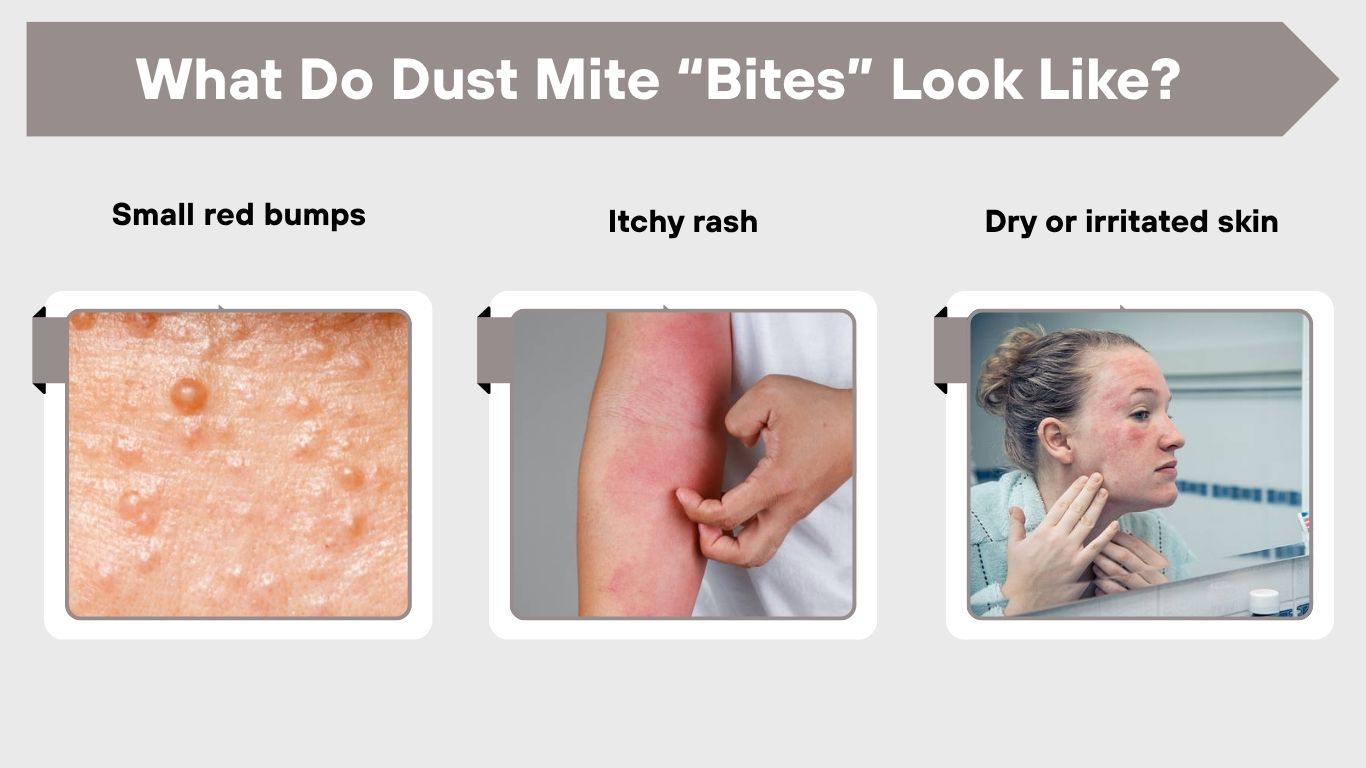 Dust Mite Bites: Symptoms, Pictures, Treatment & Bed Bug Comparison