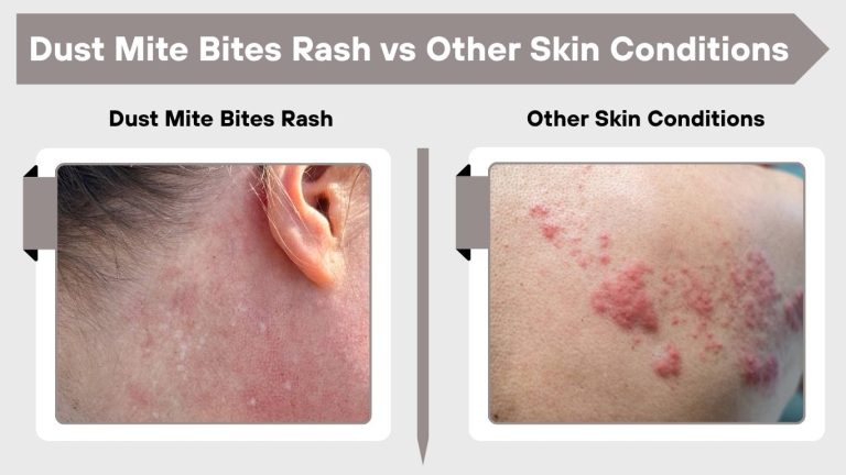 Dust Mite Bites: Symptoms, Pictures, Treatment & Bed Bug Comparison